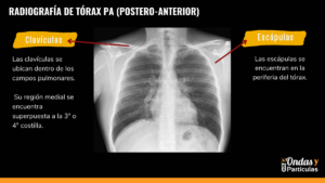 ¿Cómo interpretar una radiografía de tórax? Primera parte - Ondas y ...